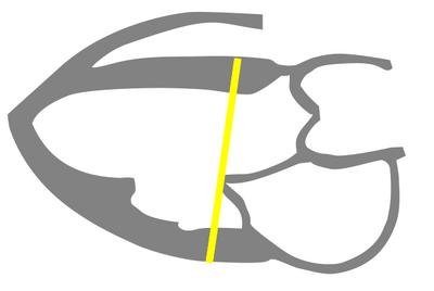 Left Ventricular Dimensions - Echopedia