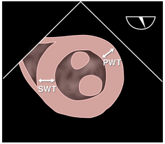 Normal Values of TEE - Echopedia
