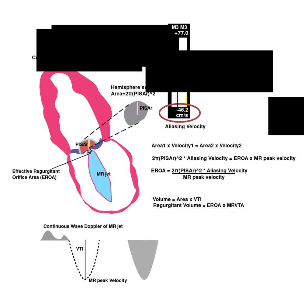 Mitral Insufficiency - Echopedia