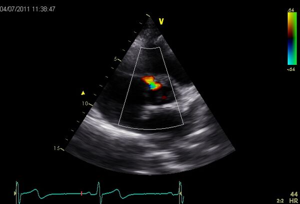 Ventricular Septal Defect (VSD) - Echopedia