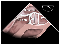 Normal Values of TEE - Echopedia