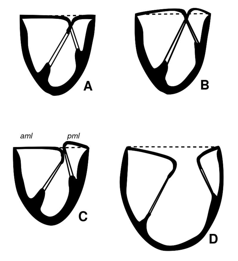 Mitral Insufficiency - Echopedia