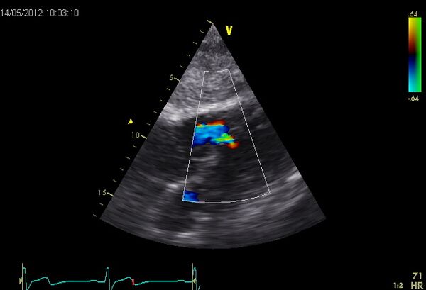 Ventricular Septal Defect (VSD) - Echopedia